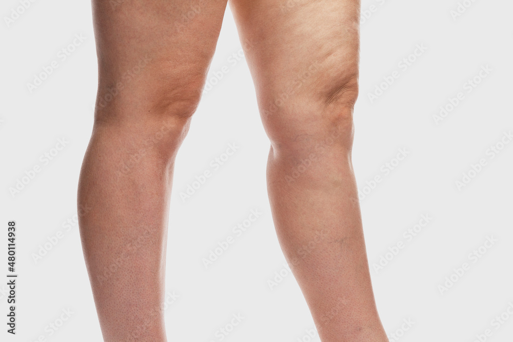 Thick female legs with cellulite and varicose veins. Overweight and ...