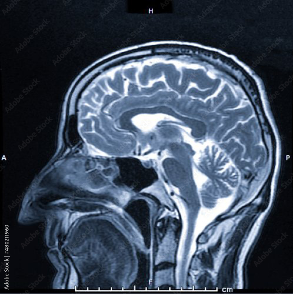magnetic resonance image (MRI) of the brain - side view image Stock ...