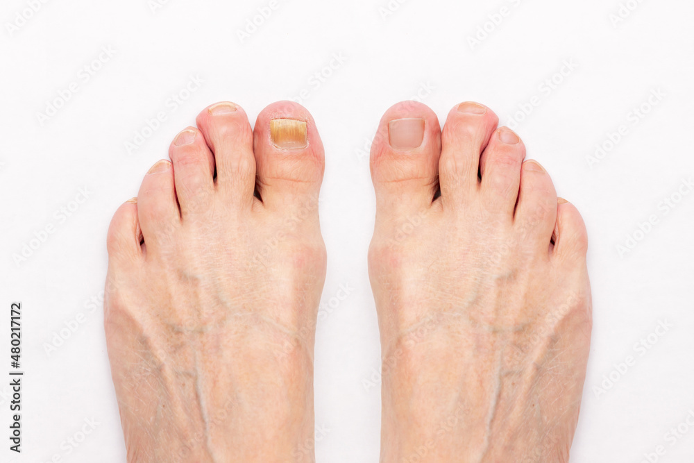 Close-up of a male foot with yellow ugly fungus on toenails and healed ...