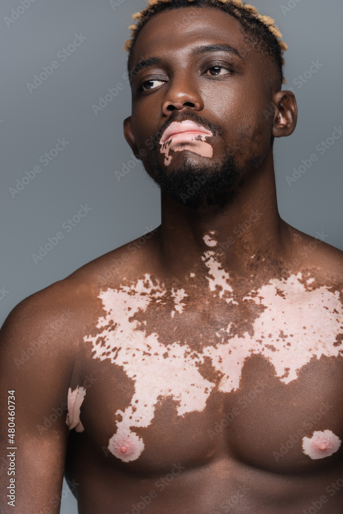 young and shirtless african american man with vitiligo skin looking ...