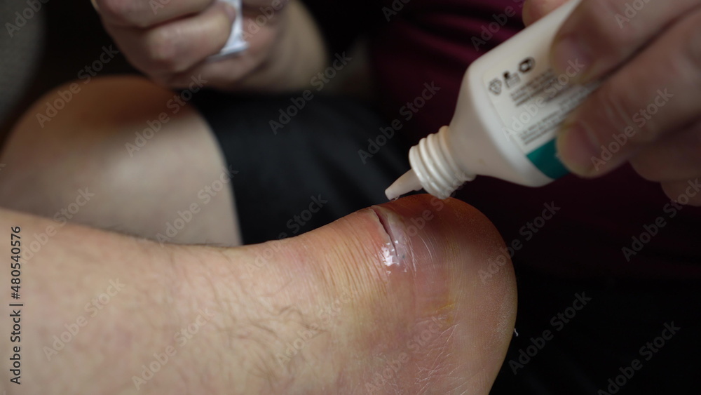 Treating a leg wound with an antiseptic. Operational incision of the ...