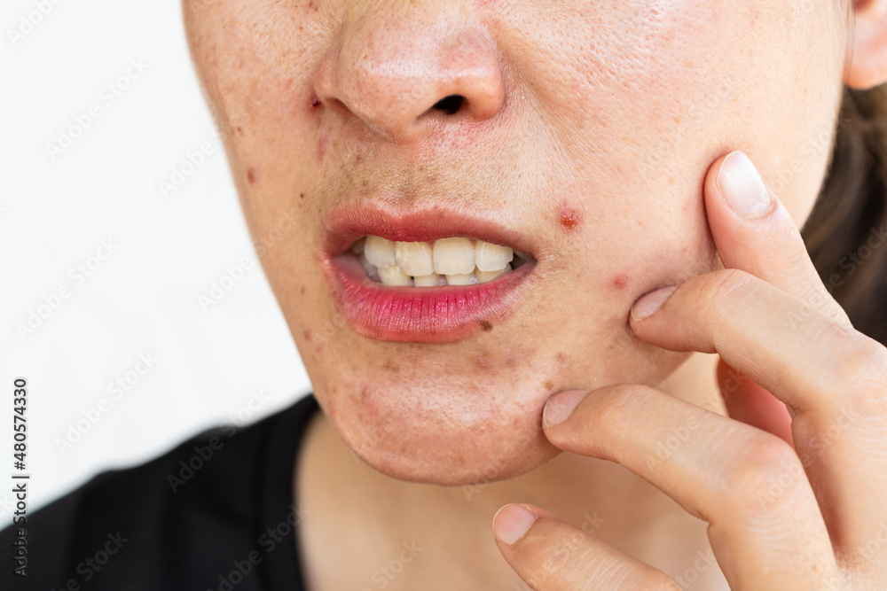 Cropped shot of woman having itch cause of acne inflamed on her face ...