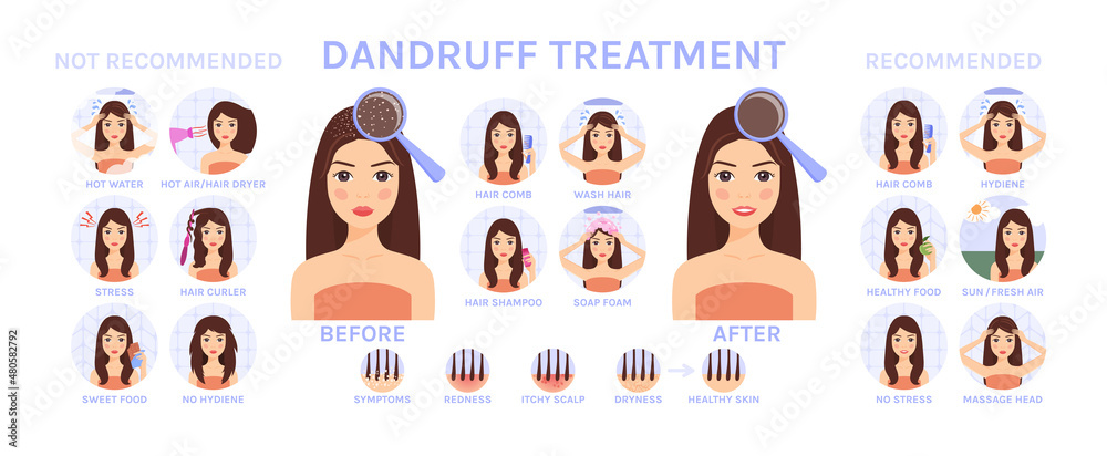 Woman with Dandruff on Head. Dandruff Treatment. Recommendations. Steps ...