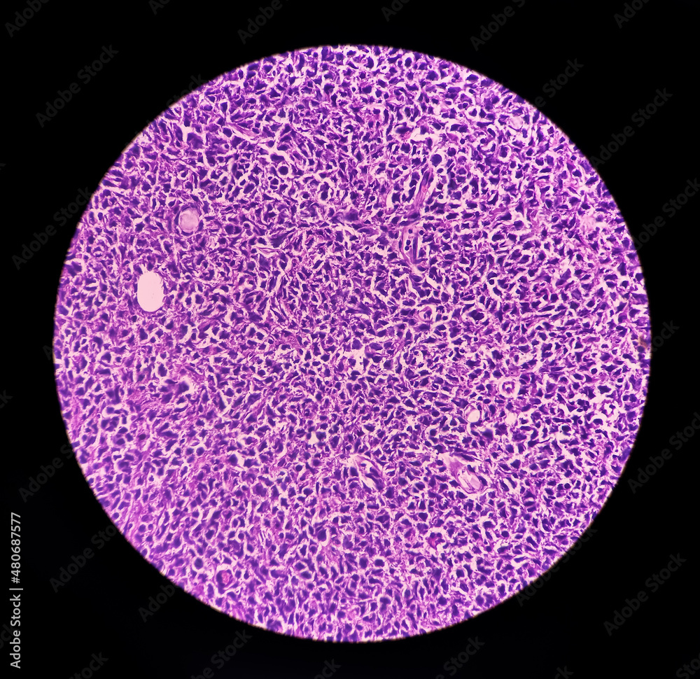 Microscopic image of Colorectal carcinoma and Amelanotic melanoma. Show ...