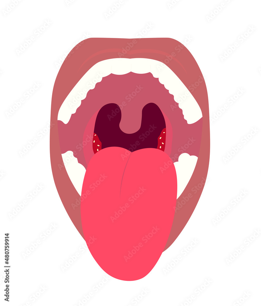 Tonsillitis. Inflammation of the tonsils in a open mouth view. Stock ...