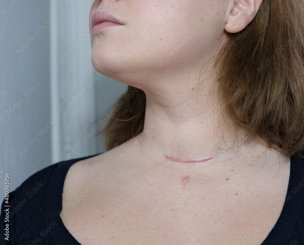 Scar on the neck. surgical wounds, removal of tumor and thyroid cancer ...