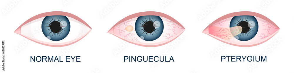 Eye healthy, with pinguecula and pterygium growing onto cornea ...