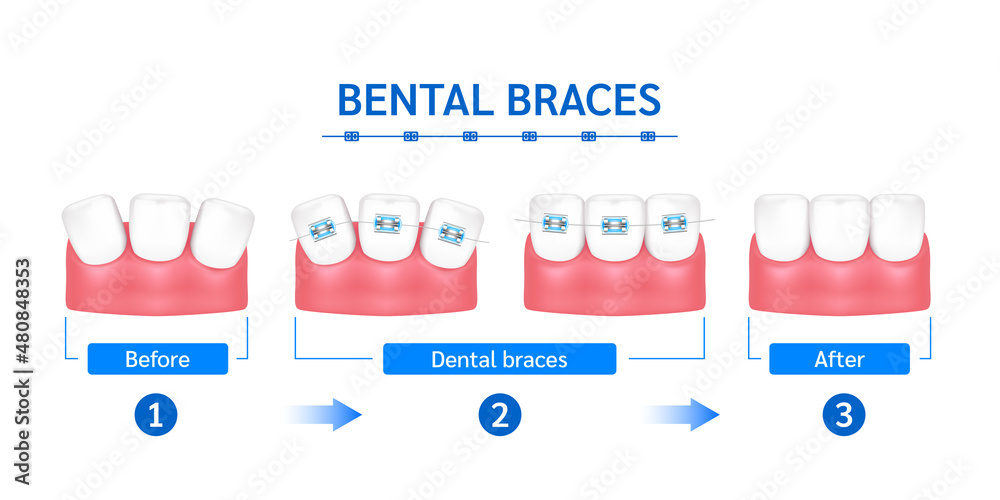 Orthodontic treatment style fashion beautiful blue before and after ...