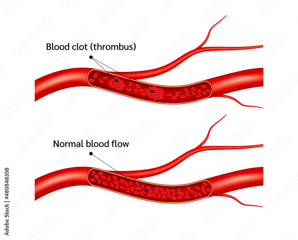 Blood clot (thrombus) in human blood vessels. High ldl and hdl level ...