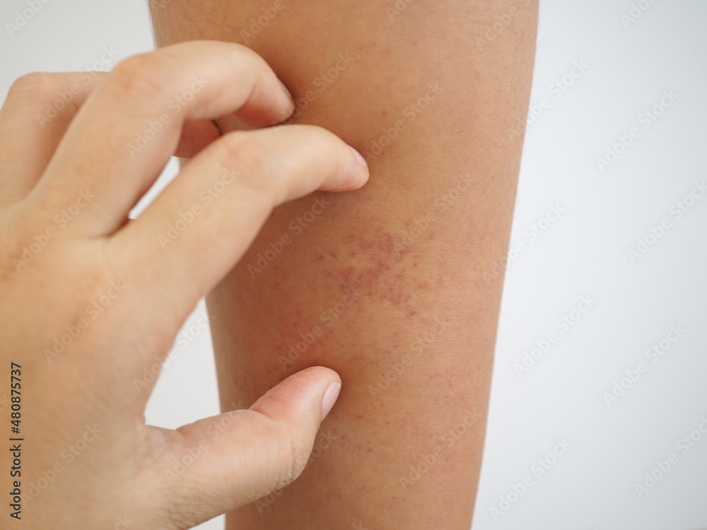A woman itches and scratches an area of thromboembolic disease, which ...