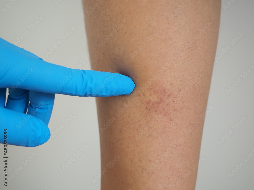 Doctor points to a thromboembolic part of her leg, which is bleeding ...