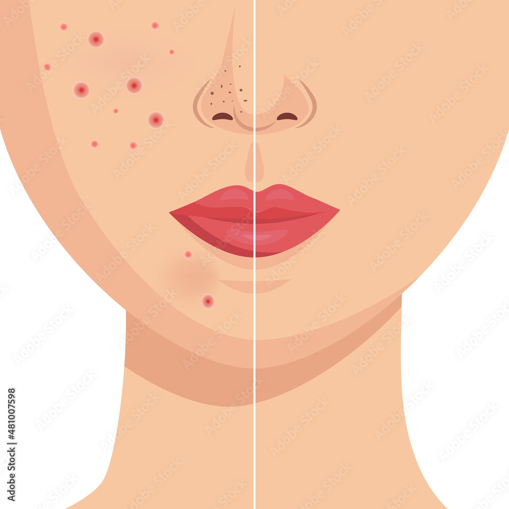 vector illustration of acne before after. skin care concept. comparison ...
