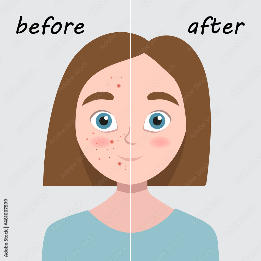vector illustration of acne before after. cartoon character girl with ...