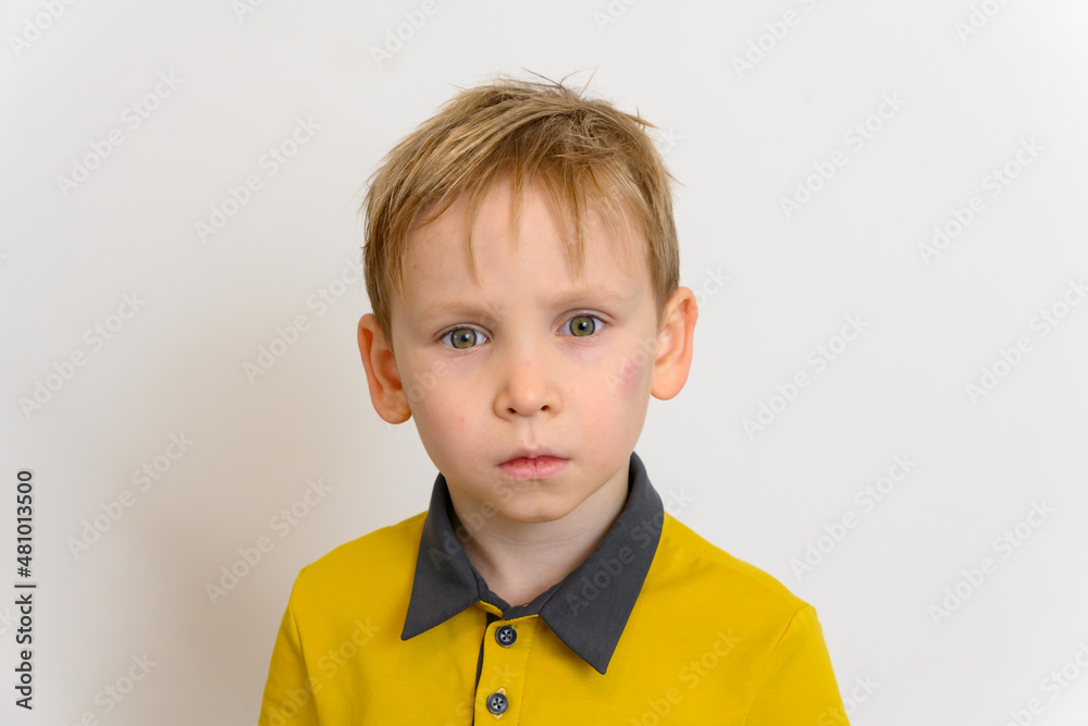 A hematoma on the face under the boy's left eye. Injury in a fall. The ...