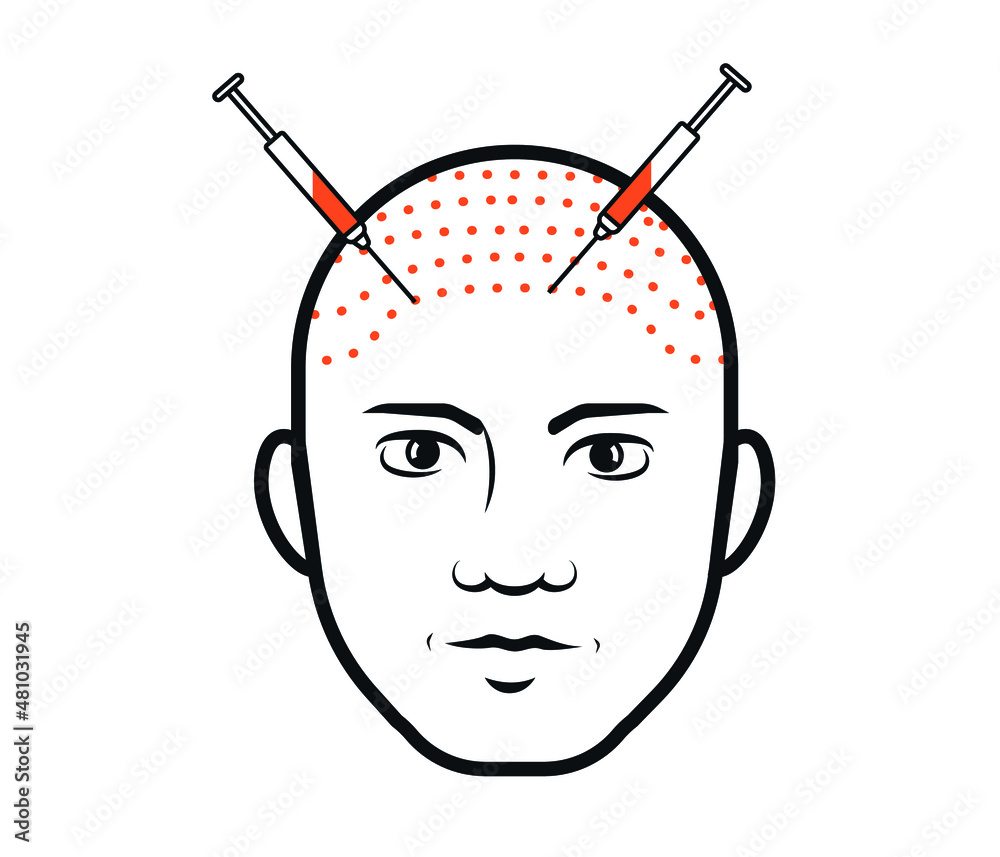 Hair loss treatment. Hair loss. Bald place on scalp. Vector ...