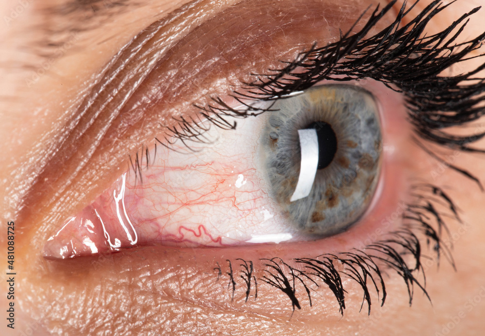Inflamed reddened eye of a girl, close-up. Dilation of the blood ...