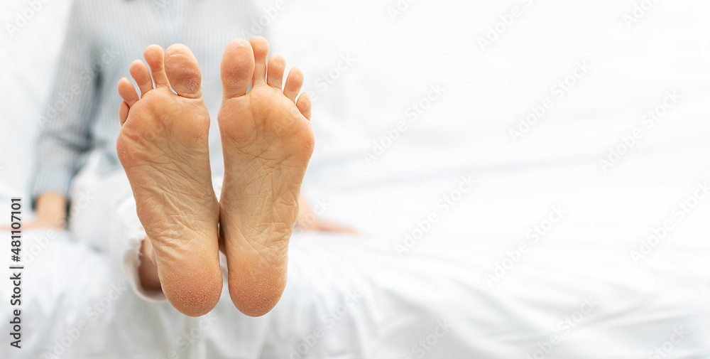 Dry skin of feet, cracked sole with scales. Dermatitis, peeling, eczema ...