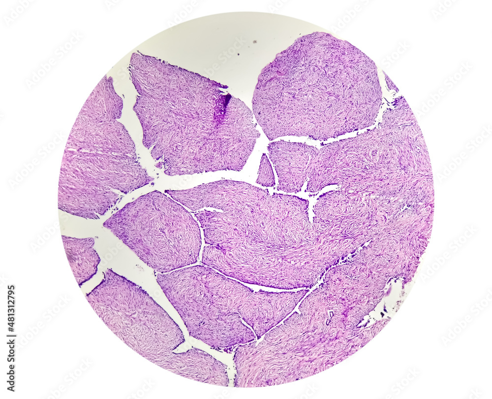 Tissue from scalp: tumors of Skin, microscopic image of a ...