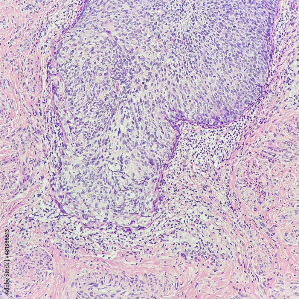 Camera photo of early invasive squamous cell carcinoma, arising from ...
