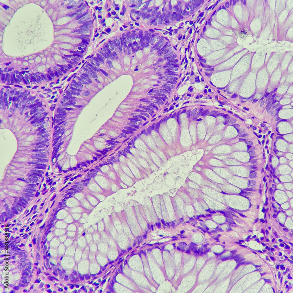 Camera photo of colonic tubular adenoma, showing dysplastic gland in ...