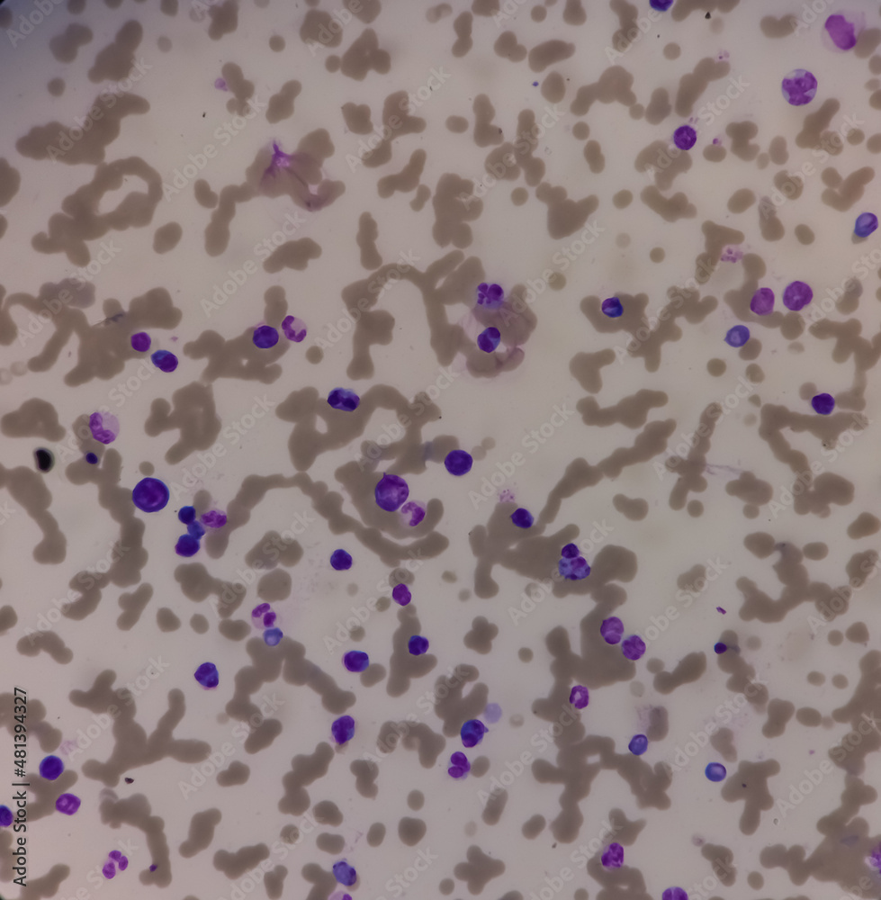 Microscopic view of blood film, plasma cell leukemia, plenty atypical ...