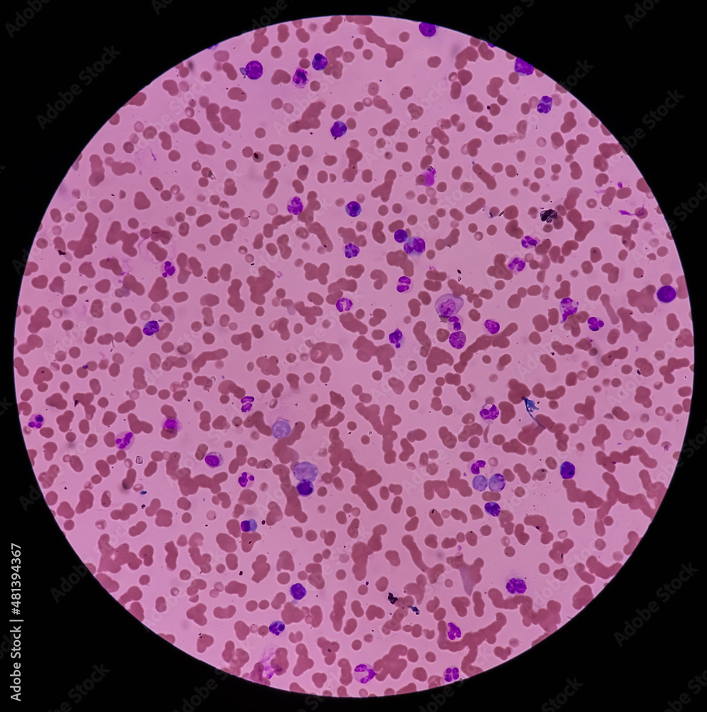 Microscopic view of blood film, plasma cell leukemia, plenty atypical ...