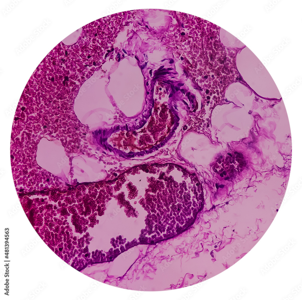 Tissue from gallbladder cyst, microscopic image of choledochal cyst ...