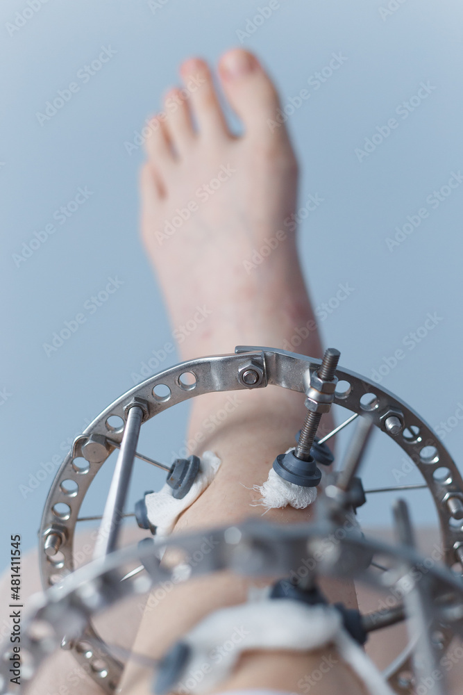 leg in Ilizarov's external fixator, Ilizarov's apparatus Stock Photo ...