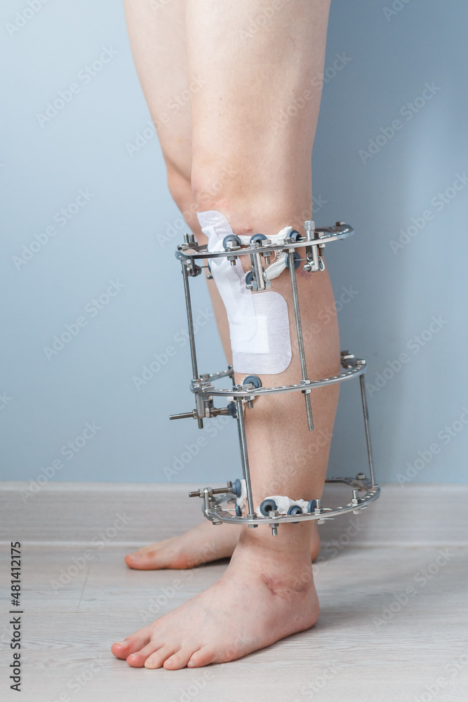 leg in Ilizarov's external fixator, Ilizarov's apparatus Stock Photo ...