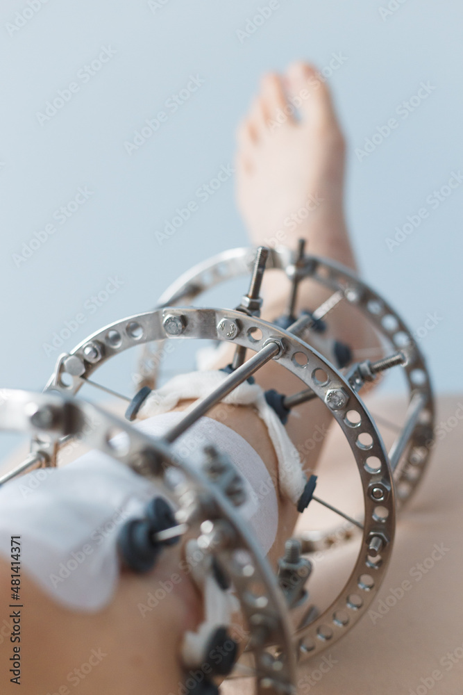 leg in Ilizarov's external fixator, Ilizarov's apparatus Stock Photo ...