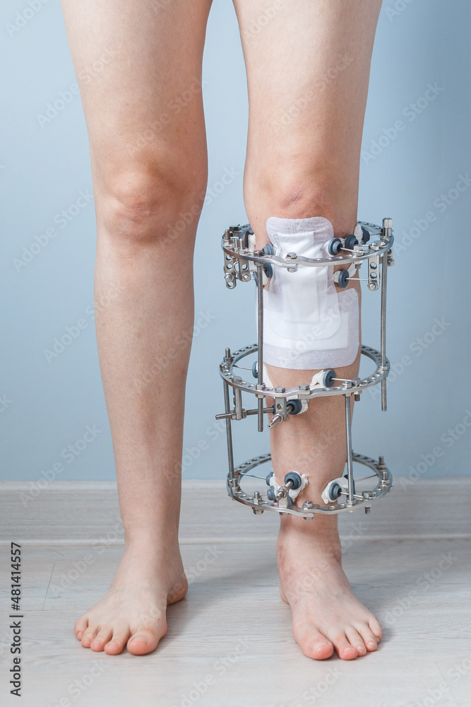leg in Ilizarov's external fixator, Ilizarov's apparatus Stock Photo ...