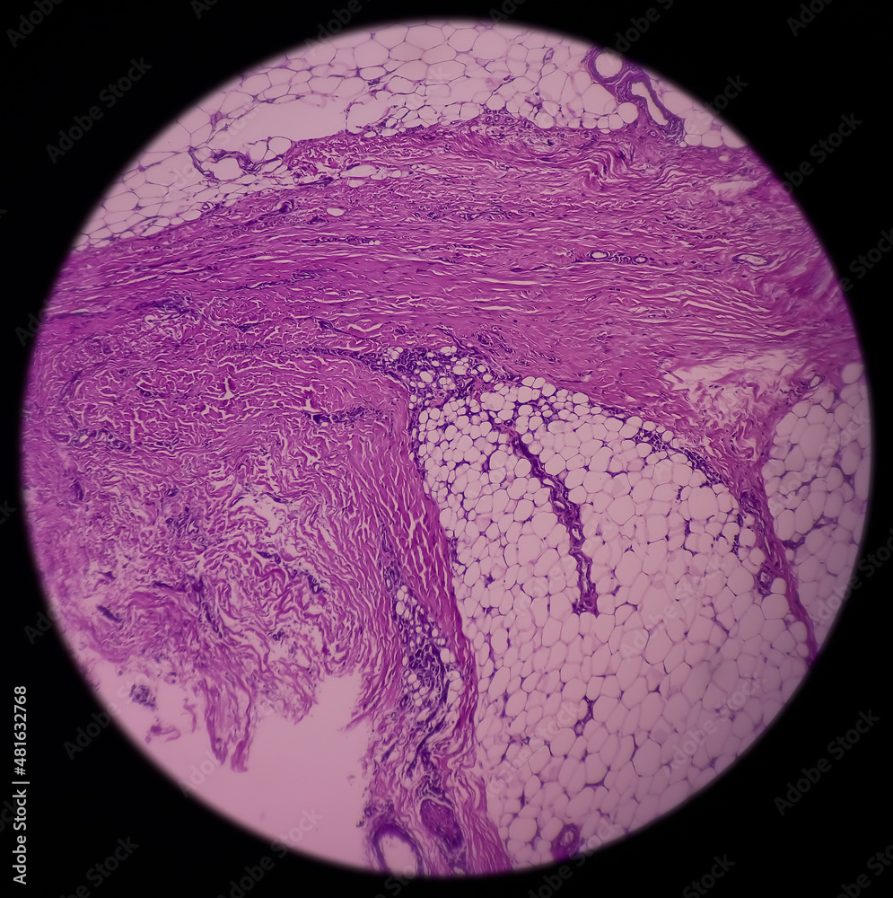 Scar endometriosis, microscopic image show fibrocollagenous tissue ...