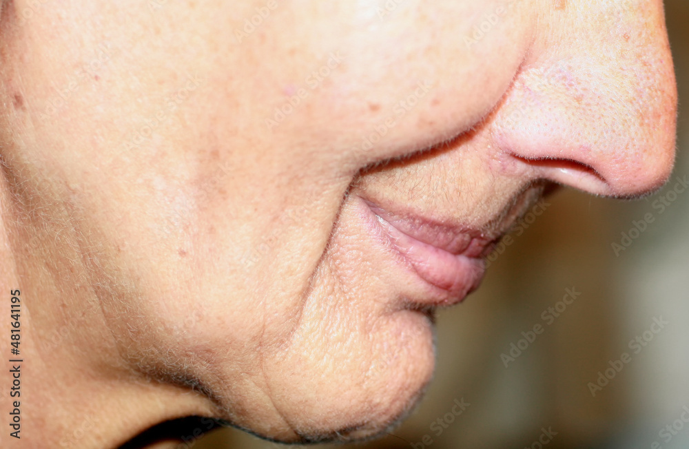 Flabbiness of the skin of the cheeks. Wrinkles on the face. Nasolabial ...