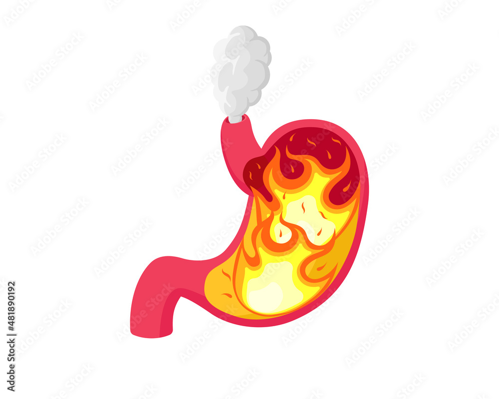 Stomach heartburn with burning acid inside. Digestive system gastritis ...