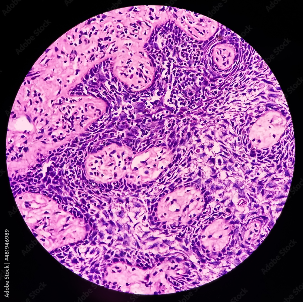 Oral mucosa carcinoma: Squamous cell carcinoma, poorly differentiated ...