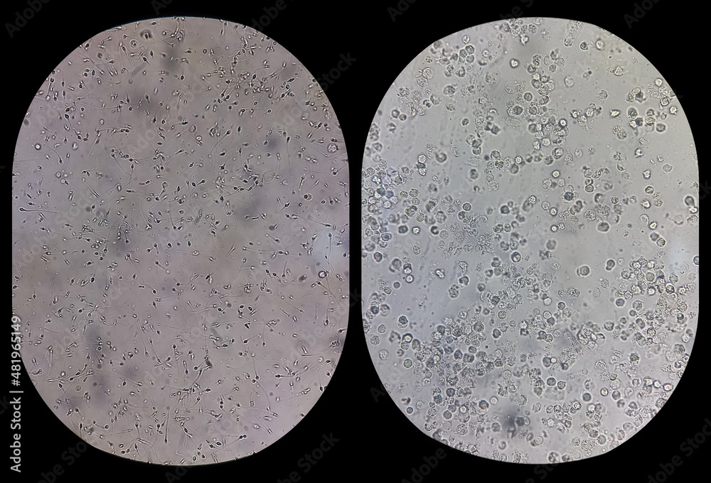 Sperm morphology. Semen photo under microscope. Micrograph showing ...