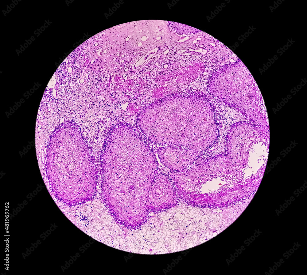 Photomicrograph of an sinonasal inverted papilloma (SNIP), a benign ...