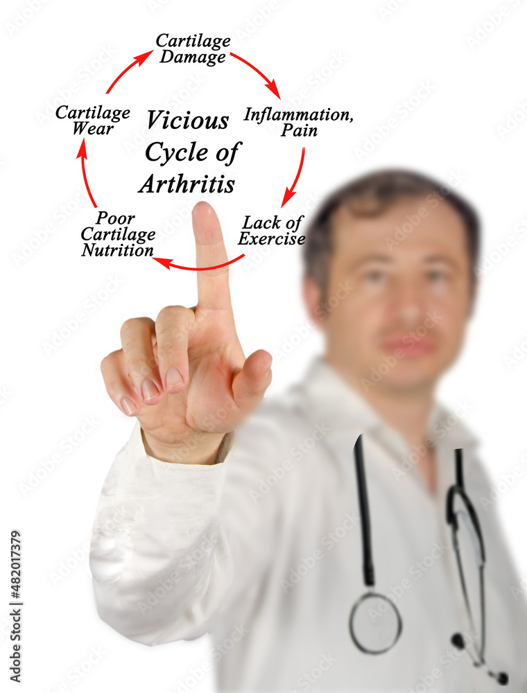 Steps in Vicious Cycle of Arthritis Stock Photo | Adobe Stock Steps in Vicious Cycle of Arthritis Stock Photo | Adobe Stock