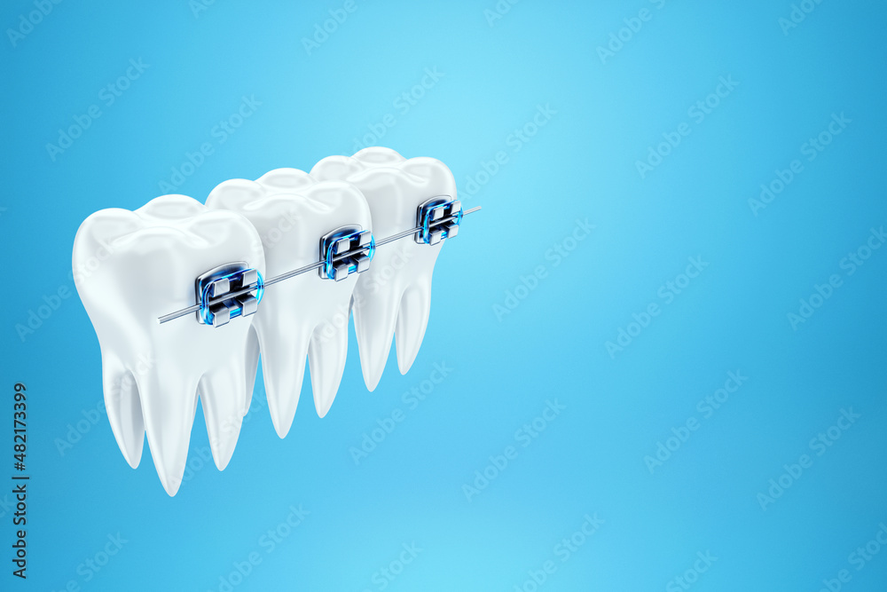 White teeth with metal braces on a blue background. Dental braces ...