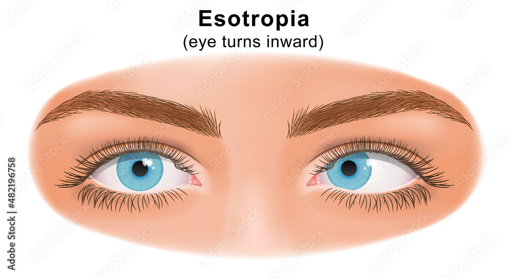 Stockvector Squint eye (Strabismus). Esotropia, eye turns inward ...