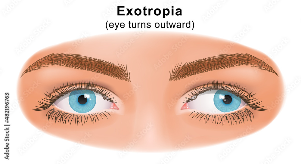 Squint eye (Strabismus). Exotropia, eye turns outward. Deflection of ...