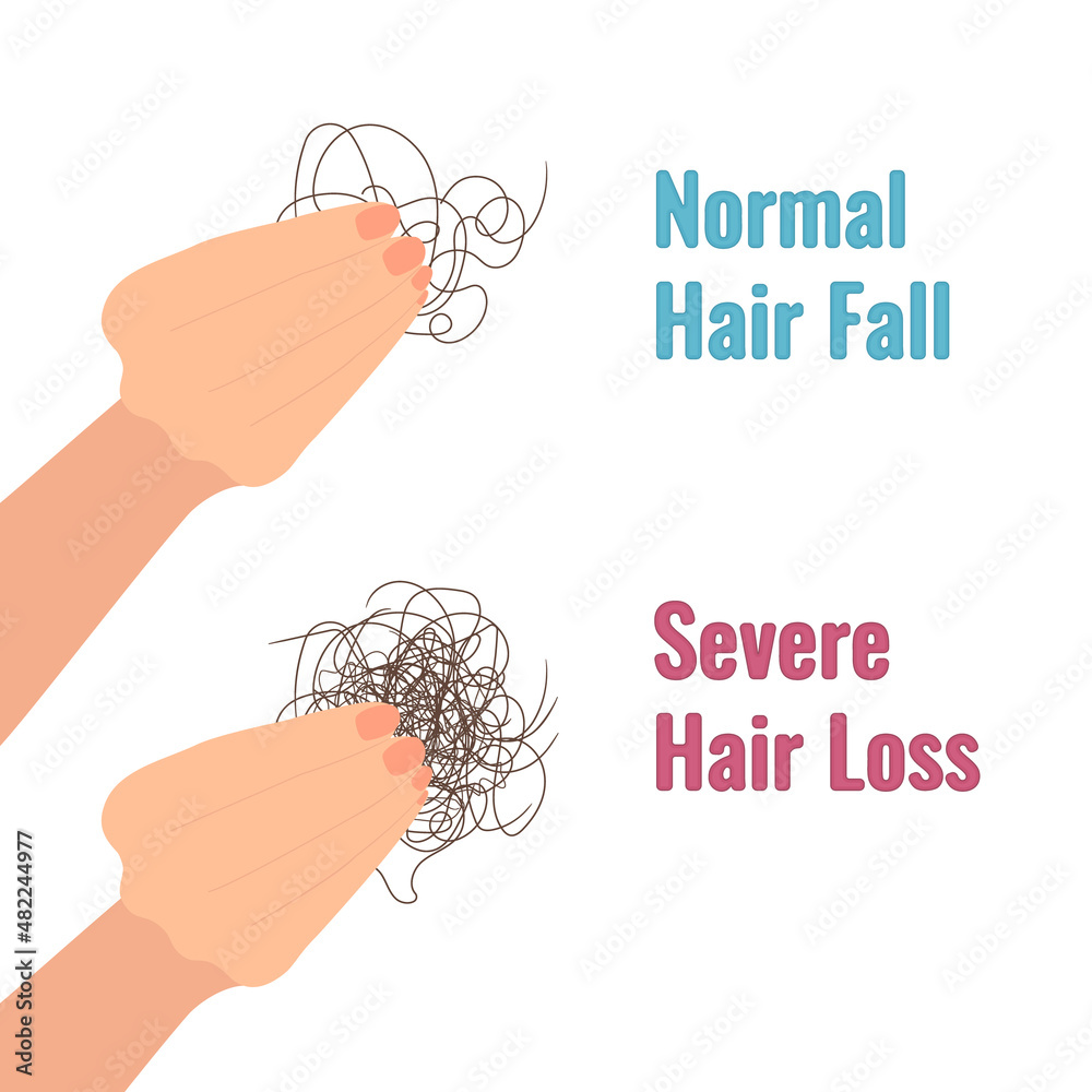 Hand holding hair clump. Normal hair fall versus severe hair loss ...