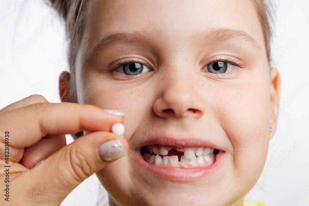 Torn out milk tooth between two fingers in front of little girl face ...