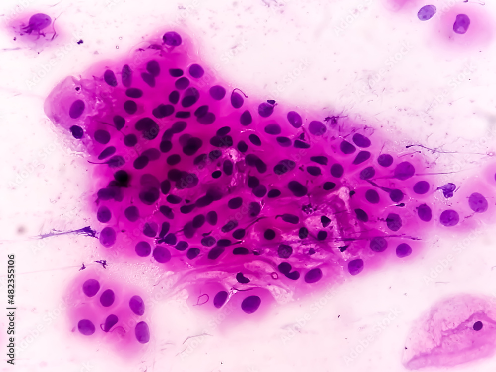 Pap's smear pap stain Microscopic 100x Zoom show High-grade squamous ...