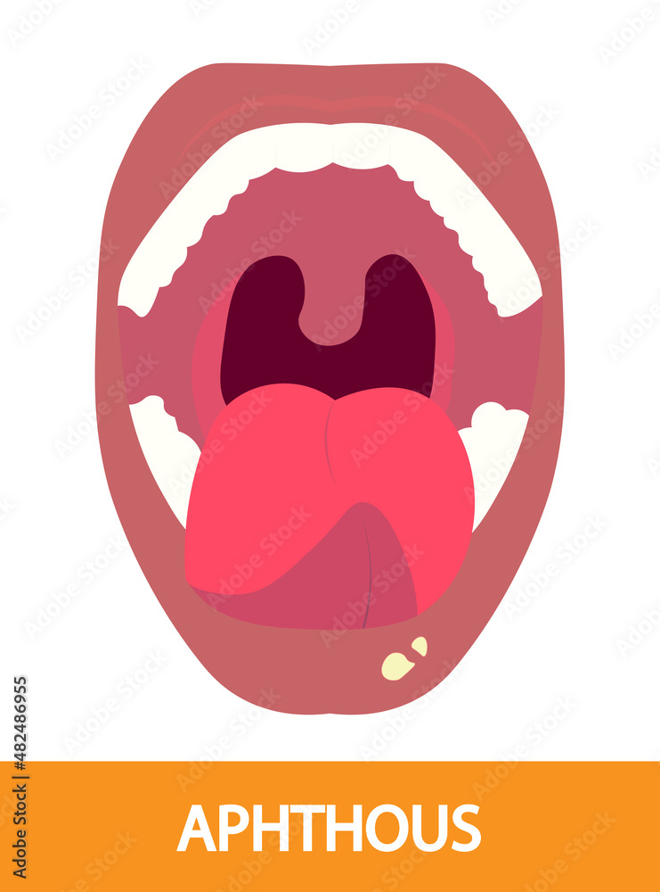Aphthous ulcers. Illustration of a aphthous in the lower lips Stock ...