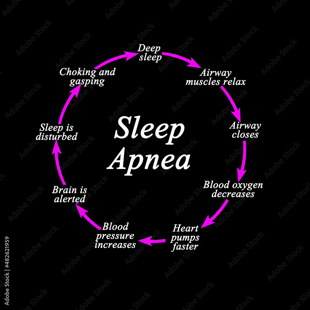 Nine Stages in Development of Sleep Apnea Stock Illustration | Adobe Stock