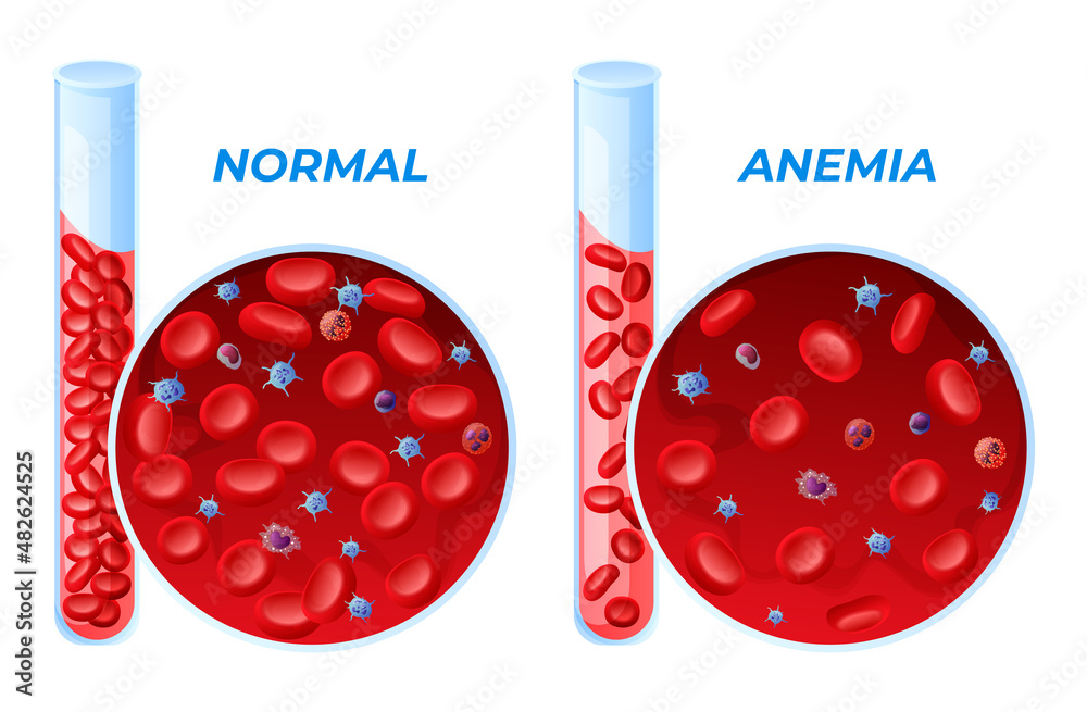 Iron deficiency anemia and normal set vector illustration difference of ... Iron deficiency anemia and normal set vector illustration difference of ...