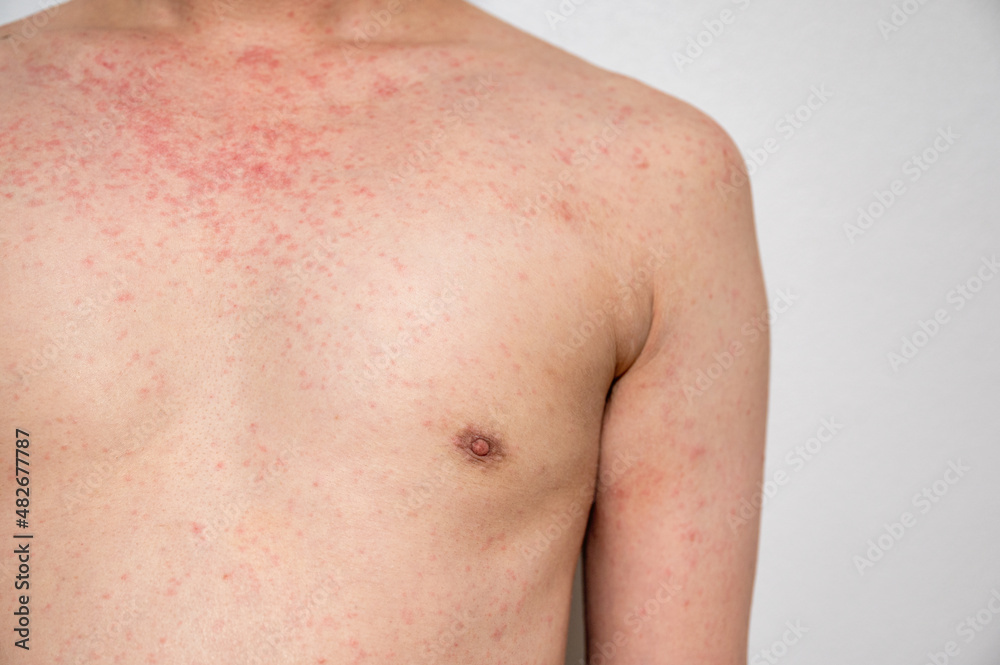 Dermatitis rash viral disease with immunodeficiency on body of young ...