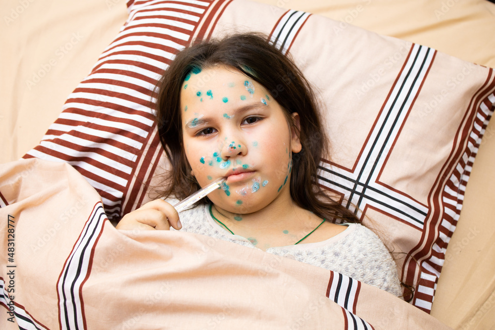An 8-10 year old Asian child with a rash from chickenpox. Chickenpox ...