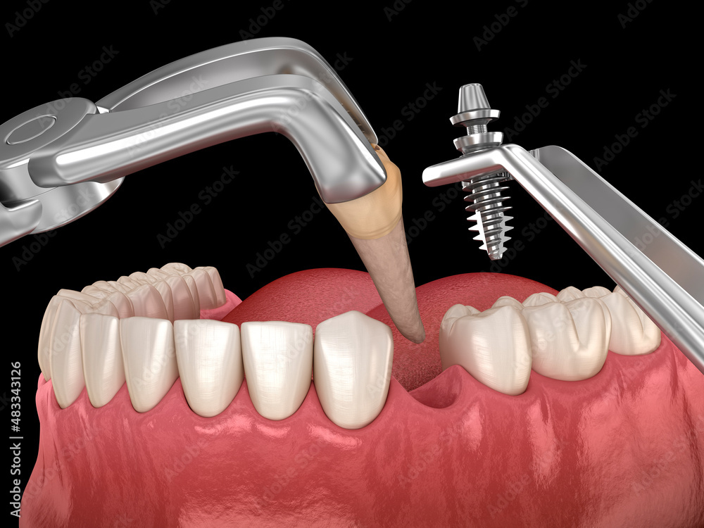 Extraction and Implantation, complex immediate surgery. Medically ...